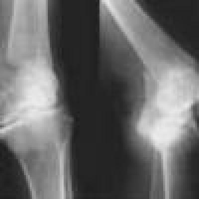 Primary Total Knee Arthroplasty for Distal Femur Fractures: A ...
