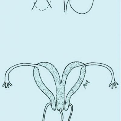 Vaginal anomalies and their surgical correction | MDedge ObGyn