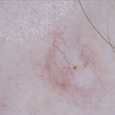 Expert offers tips for sorting out pink lesions on dermoscopy | MDedge ...