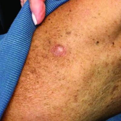 An 80-year-old patient presents with an asymptomatic firm pink plaque ...