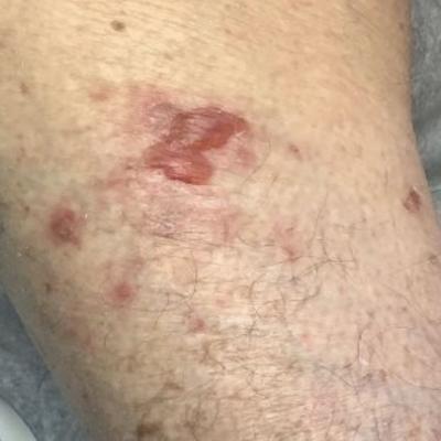 A 95-year-old White male with hypertension presented with itchy patches ...