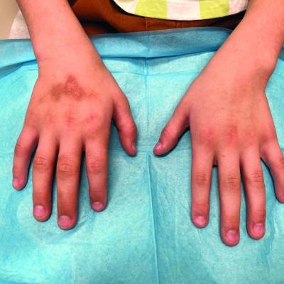 An 8-Year-Old Male With Asymptomatic Brown Rough Plaques on the Dorsum ...