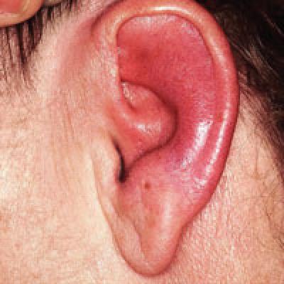 Seeing Redness and Ear-itation | Clinician Reviews