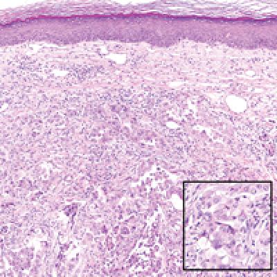 Rapidly Growing Scalp Nodule | MDedge Dermatology