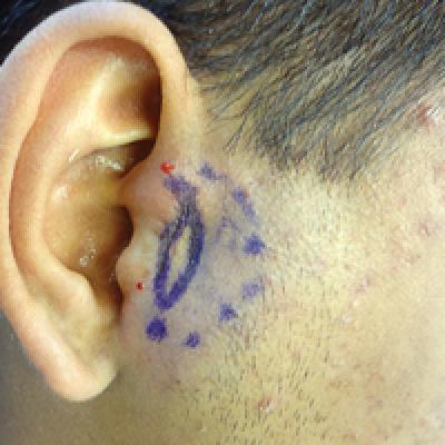 Diagnosis of a Rapidly Growing Preauricular Nodule: Chondroid Syringoma ...