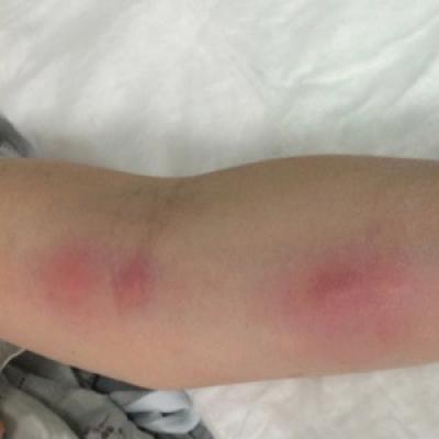 Ascending Erythematous Nodules on the Arm | MDedge Dermatology
