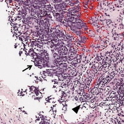 Lambert-Eaton Myasthenic Syndrome and Merkel Cell Carcinoma | MDedge ...