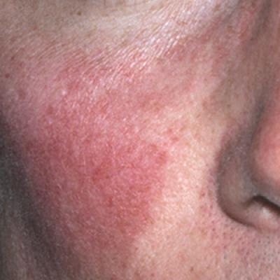 Update on Rosacea Classification and Its Controversies | MDedge Dermatology