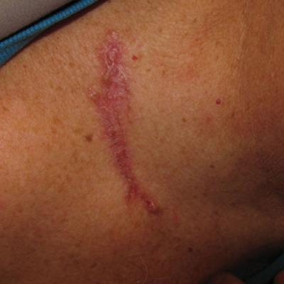 Recurrence of Linear Basal Cell Carcinoma | MDedge Dermatology
