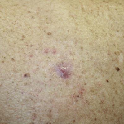 Clinical Pearl: Topical Timolol for Refractory Hypergranulation ...