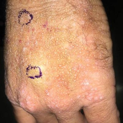 Smooth Papules on the Left Hand | MDedge Dermatology