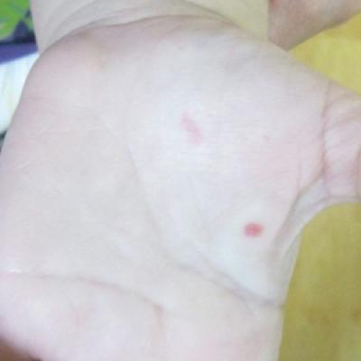 Broadly Distributed Vascular Macules in a Pediatric Patient | MDedge ...