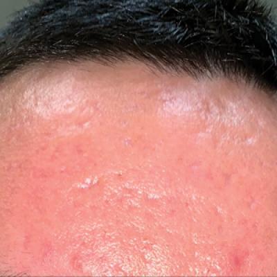 Fighting Acne for the Fighting Forces | MDedge Dermatology