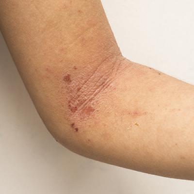 Update on Pediatric Atopic Dermatitis | MDedge Dermatology