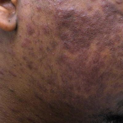 Widespread Purple Plaques | MDedge Dermatology
