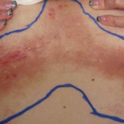 Severe Refractory Hailey-Hailey Disease Treated With Electron Beam ...