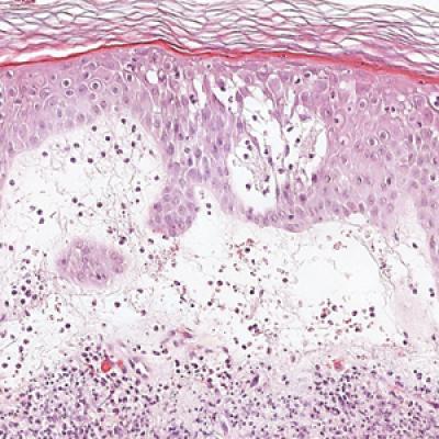 Tender, Diffuse, Edematous, and Erythematous Papules on the Face, Neck ...