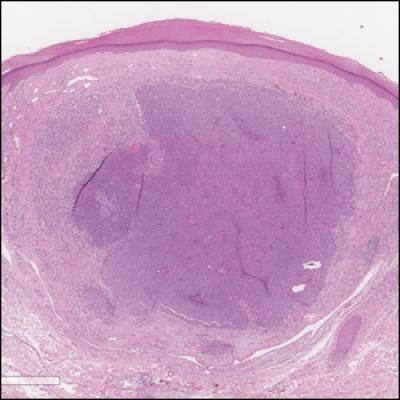 Early Pilomatrix Carcinoma: A Case Report With Emphasis on Molecular ...