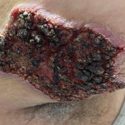 Fungated Eroded Plaque on the Arm | Clinician Reviews