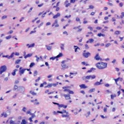 Firm Exophytic Tumor on the Shin | MDedge Dermatology