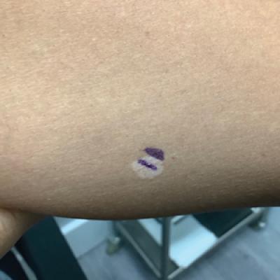 White Spots on the Extremities | MDedge Dermatology
