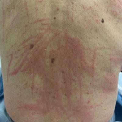 Raised Linear Plaques on the Back | Clinician Reviews