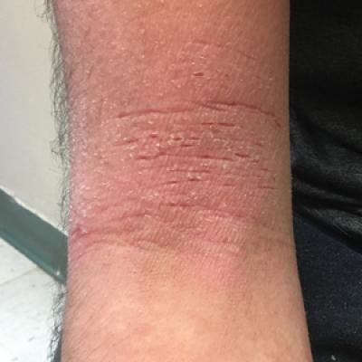 Atopic Dermatitis Triggered by Omalizumab and Treated With Dupilumab ...