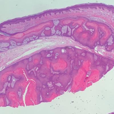 Hyperkeratotic Nodule on the Knee in a Patient With KID Syndrome ...