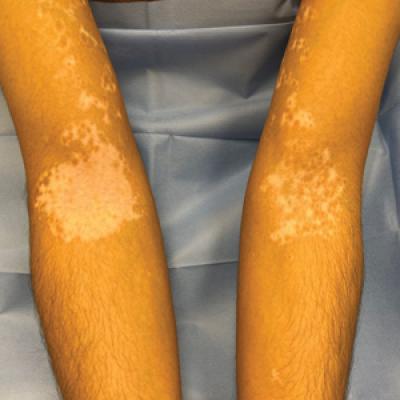 Advancements in Targeted Therapies for Vitiligo: Prioritizing Equity in ...