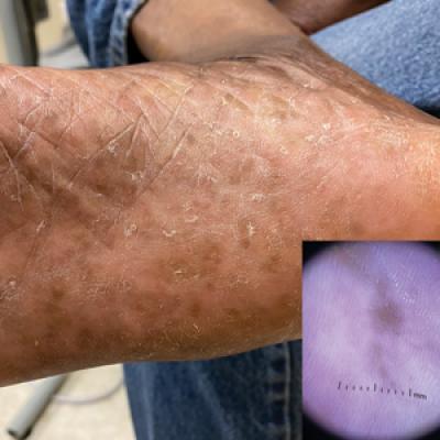 Plantar Hyperpigmentation | MDedge Dermatology