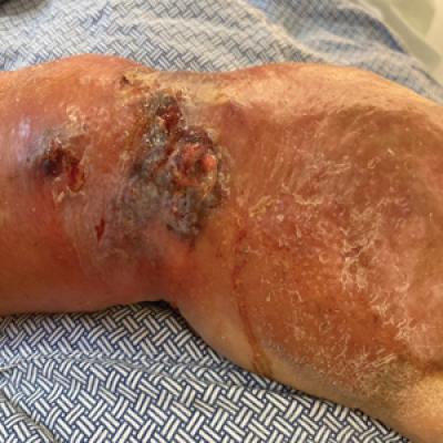 Rapidly Progressive Necrotizing Myositis Mimicking Pyoderma Gangrenosum ...