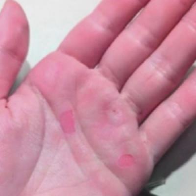 Isotretinoin-Induced Skin Fragility in an Aerialist | MDedge Dermatology