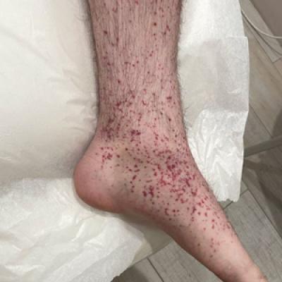 Anti-Smith and Anti–Double-Stranded DNA Antibodies in a Patient With ...