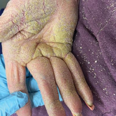 Misdiagnosis of Crusted Scabies: Skin Excoriations Resembling Brown ...