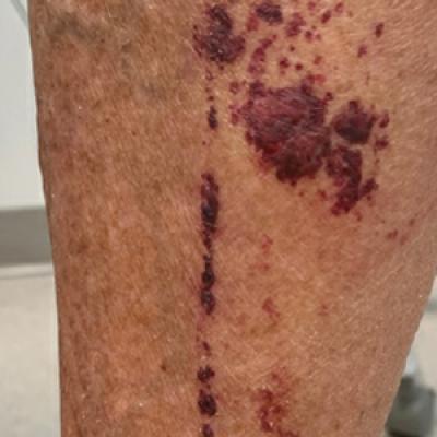 Purpuric Lesions on the Leg | MDedge Dermatology