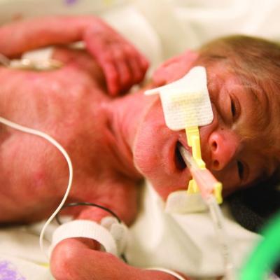 Extremely preterm infants fare better with corticosteroid and magnesium ...
