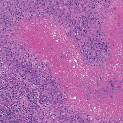 Ulcerating Nodule on the Foot | MDedge Dermatology