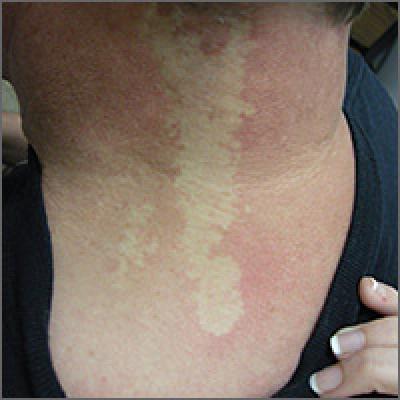 Light skin on back of neck | MDedge Family Medicine