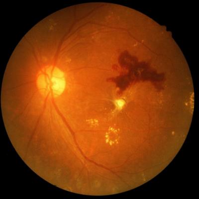 FDA approves marketing for retinal imaging device that uses artificial ...