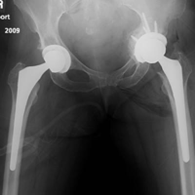 Management and Prevention of Intraoperative Acetabular Fracture in ...