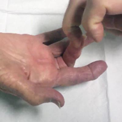 Percutaneous Trigger Finger Release | MDedge Surgery