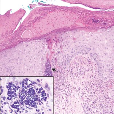 Tetrad Bodies in Skin | MDedge Dermatology