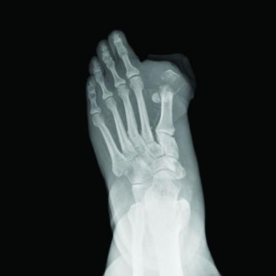 Osteomielite Raio X Pe