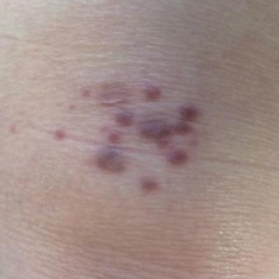 Multinucleate Cell Angiohistiocytoma | MDedge Dermatology