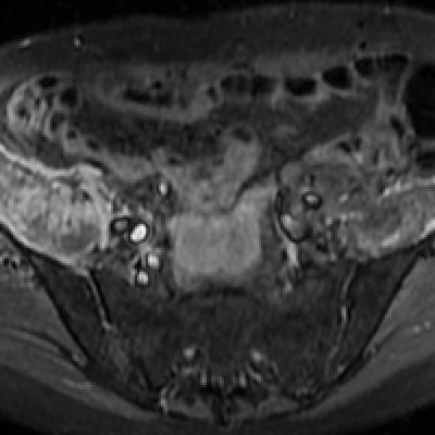 Emergency Imaging: Atraumatic Leg Pain | MDedge Emergency Medicine