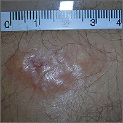 Painful growing lesion | MDedge Family Medicine