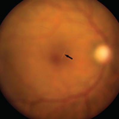 Boy, 9, With Eye Pain, Blurred Vision, and Tearing | Clinician Reviews