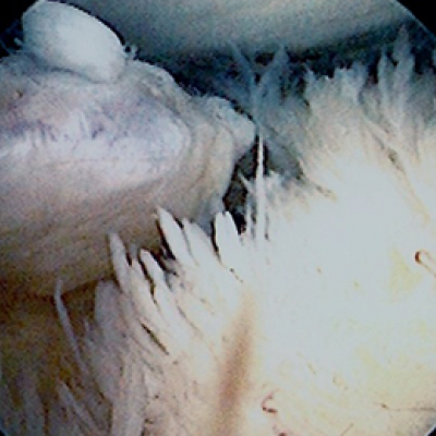 Arthroscopic Anterior Ankle Decompression Is Successful in National ...