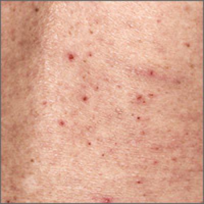 What is the most effective treatment for scabies? | MDedge Family Medicine