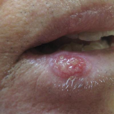 Eroded Plaque on the Lower Lip | MDedge Dermatology